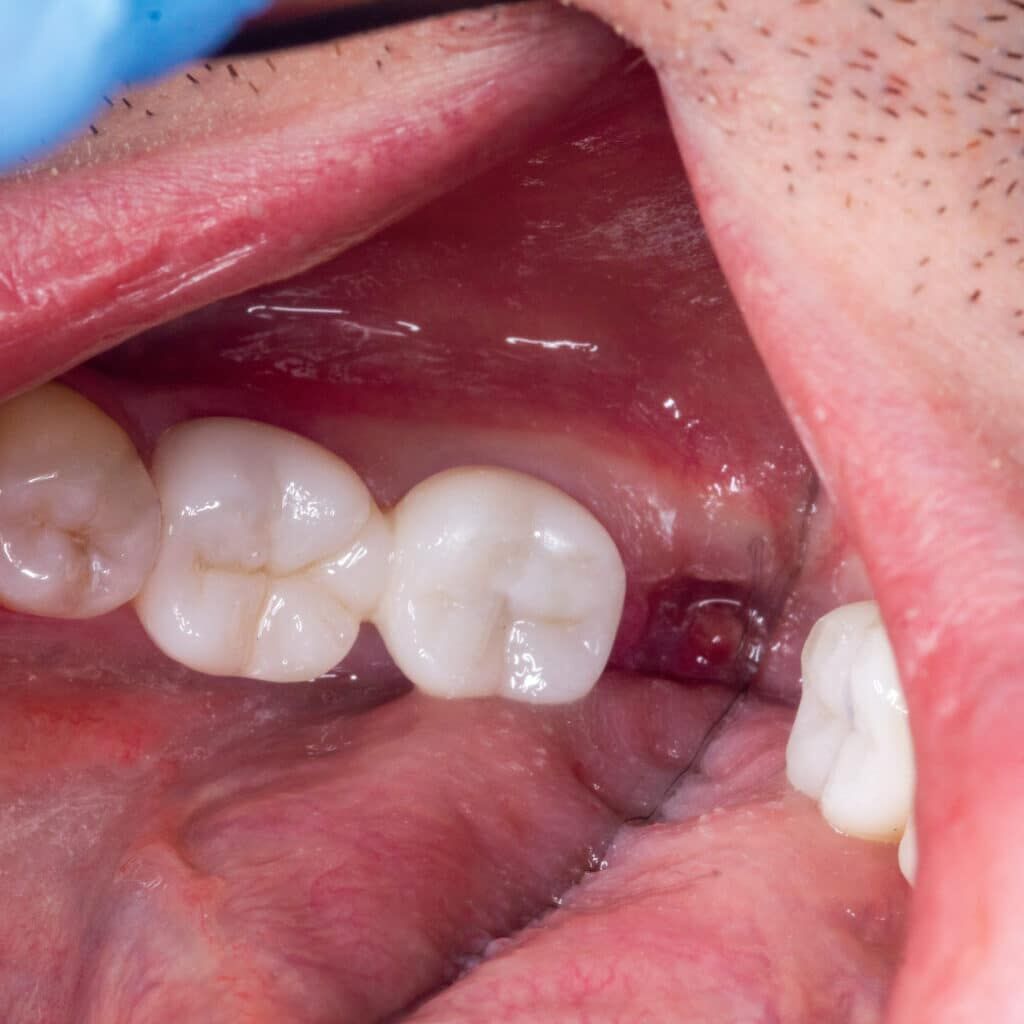 What Is the White Stuff After a Tooth Extraction?
