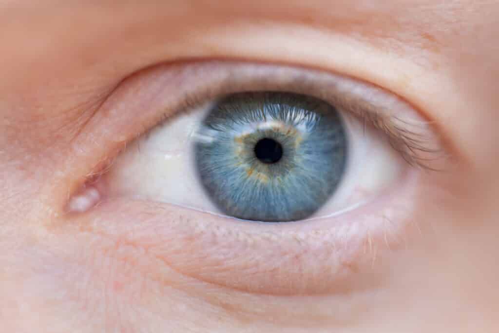 Central Heterochromia: Why Your Eyes Might be Two Colors