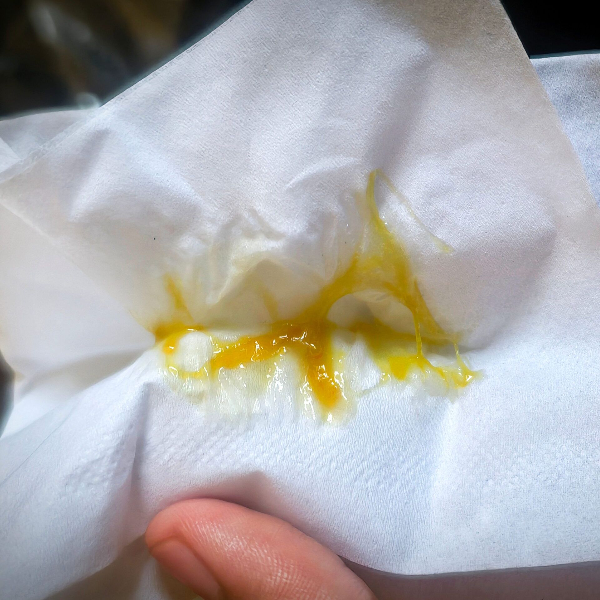 Is Green Mucus an Infection? A Guide to Color and Thickness